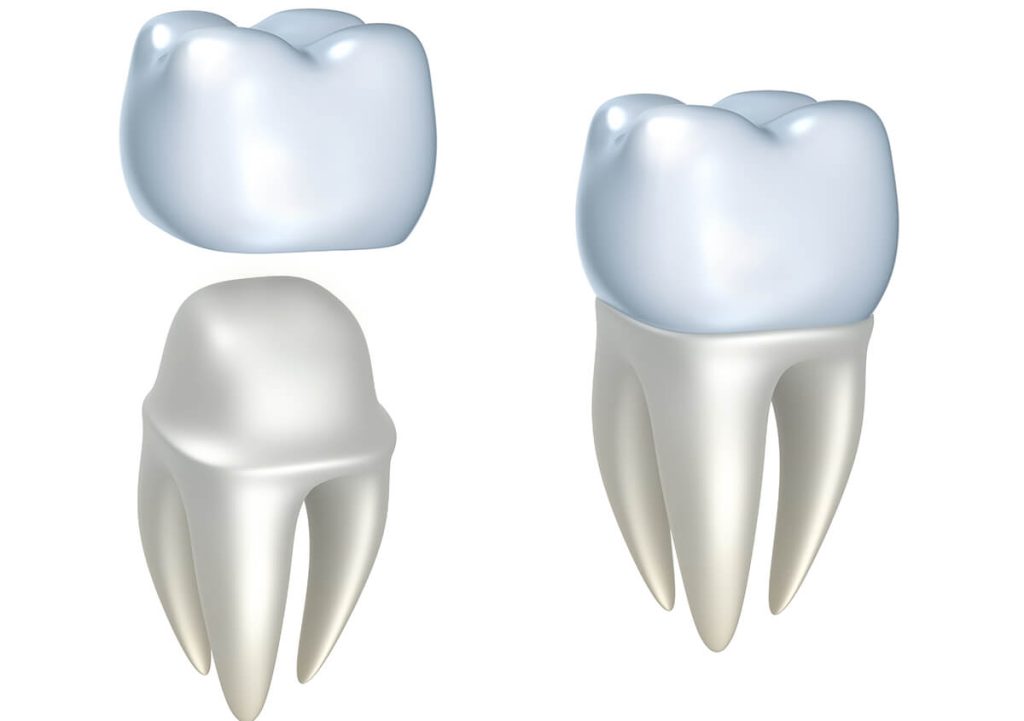 Anterior Crowns - Chestnut Ridge Dental